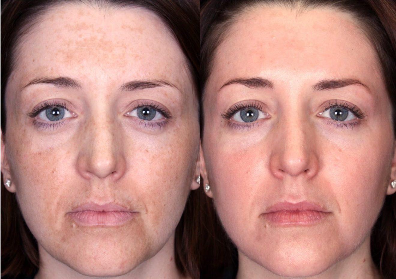 ¿Qué es el peeling? Tipos, Beneficios y riesgos para rejuvenecer la piel