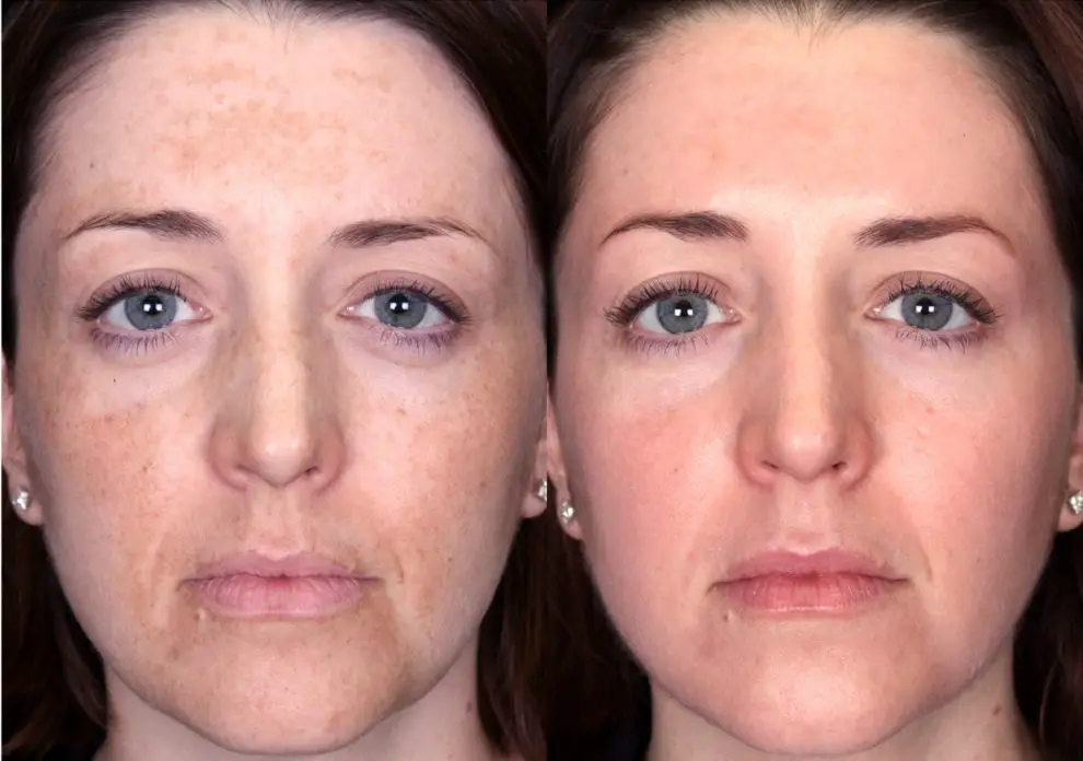 ¿Qué es el peeling? Tipos, Beneficios y riesgos para rejuvenecer la piel