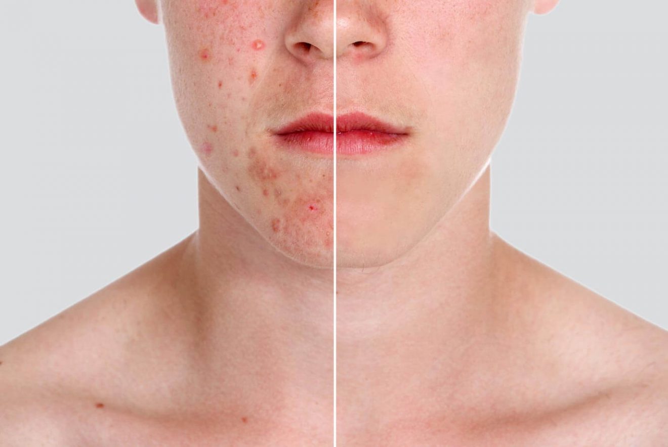 ¿Qué es exfoliar? Una técnica para tener un cutis perfecto