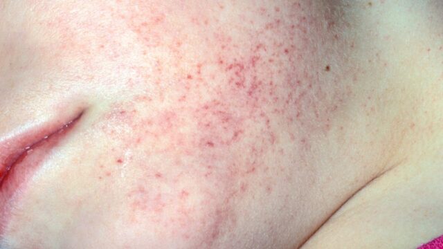 Puntos rojos en la piel de los niños ¿Cuando preocuparse?